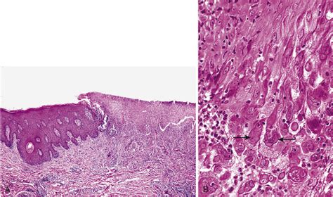 Infectious Disorders Of The Lower Genital Tract Obgyn Key