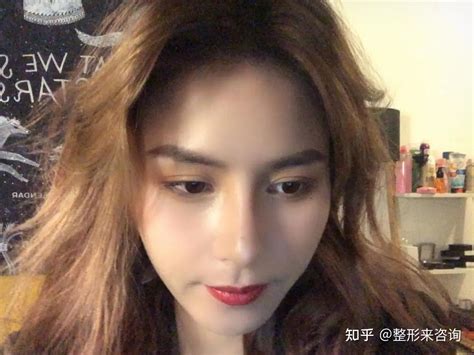 肋骨鼻什么原因必须取出？取出来后鼻子会不会塌呀？ 知乎