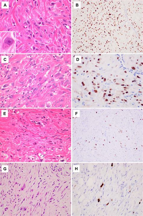Recurrent Fos Rearrangement In Proliferative Fasciitis Proliferative Myositis Modern Pathology
