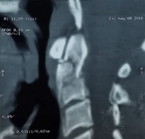 Cervical Computed Tomography With Simple Reconstruction Comminuted