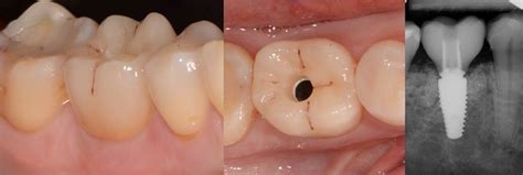 Here Is A New Case Of Immediate Implant Placement Combined With