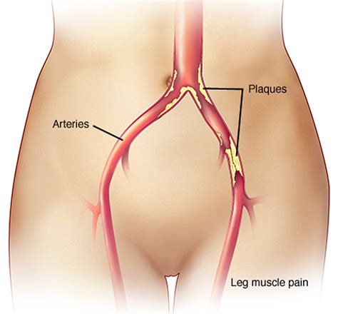Claudication Intermittent Claudication Causes Symptoms And Treatment