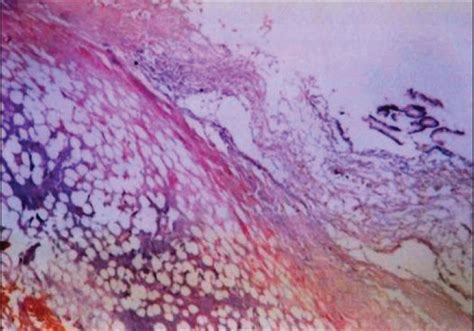 Submucous Lipoma Of Sigmoid Colon A Rare Entity Journal Of