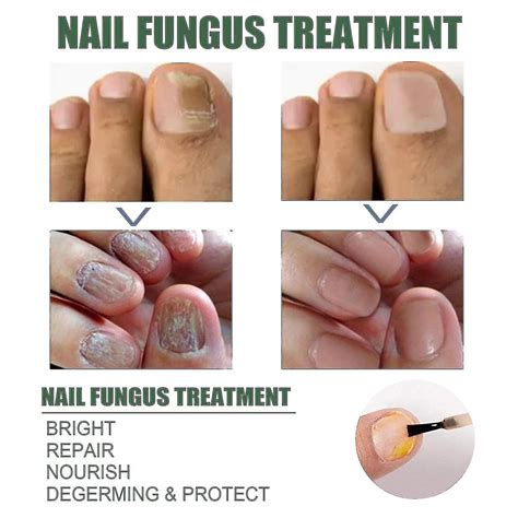 Extra Strong Nail Fungus Treatment Best Nail Repair Stop Fungal Growth