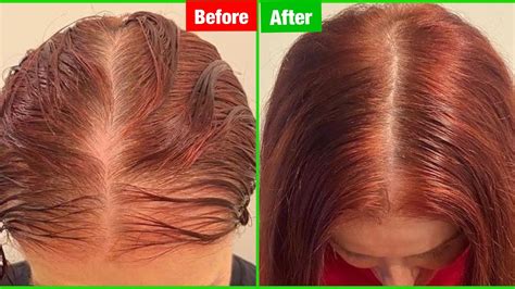 How To Stop Hair Loss And Treat Alopecia Naturally YouTube