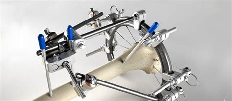 Medical External Fixators