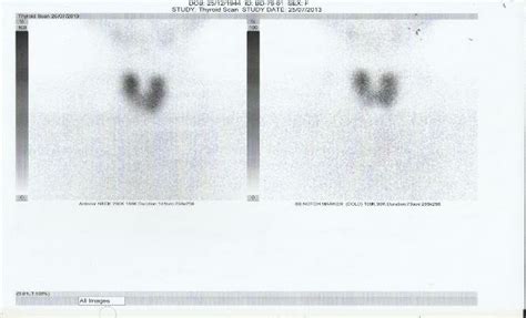 Study Of Thyroid Scan Of Patient With ID SEX M Download Scientific Diagram