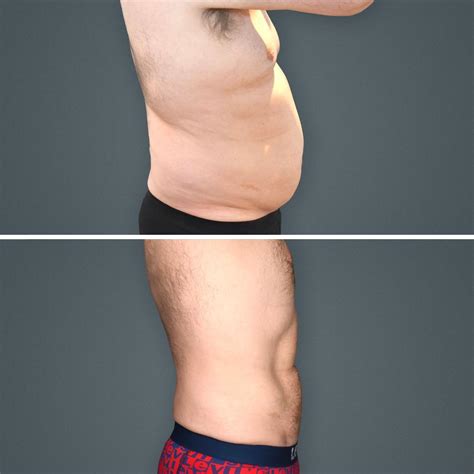 Vaser Liposuction Sydney Gold Coast Canberra Adelaide