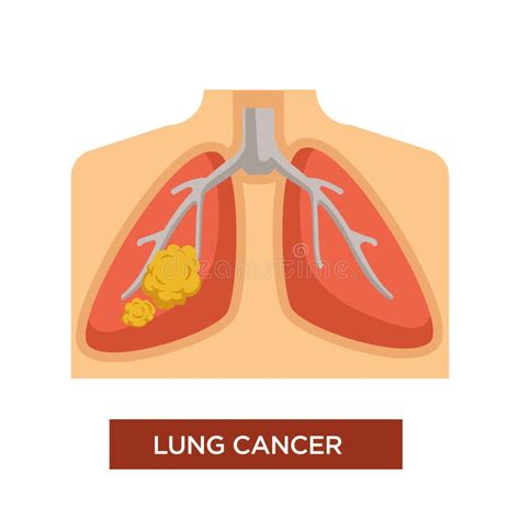 Tumor del pulmón stock de ilustración. Ilustración de biológico - 13325178