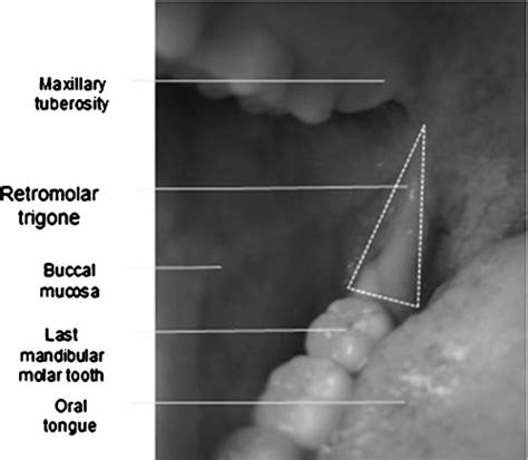 Retromolar Trigone