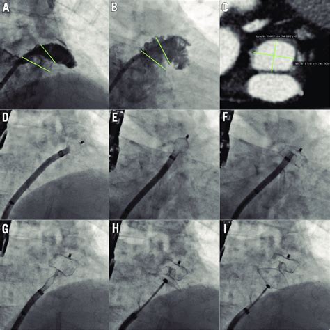 Amplatzer Amulet Step By Step Through The Transseptal Sheath By Using