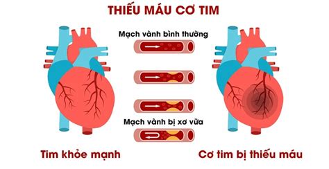 Thiếu Máu Cơ Tim Là Gì 9 Dấu Hiệu Nhận Biết Bệnh Thiếu Máu Cơ Tim Dự