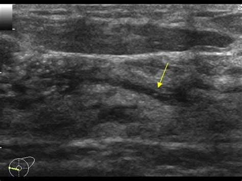 Breast And Axilla 5 2 Malignant Breast Lesions Case 5 2 13 Carcinoma In Situ And