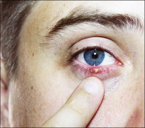 Close Up Mans Eye Ophthalmologic Disease Hordeolum Eye Doctor