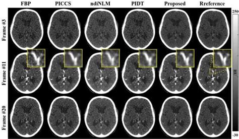 Reconstructed DCP CT Images Of Frames 3 11 And 20 For Patient 2