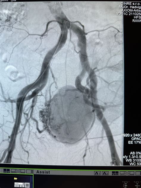 Samuel Hadvig Md Ebir On Linkedin 46y Old Patient With Pelvic Avm And Gigantic Perinidal
