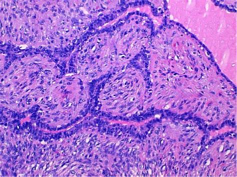 Case 7 Borderline Phyllodes Tumor This High Power View Demonstrates