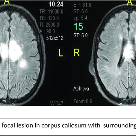 Brain T1 Magnetic Resonance Imaging Mri Download Scientific Diagram