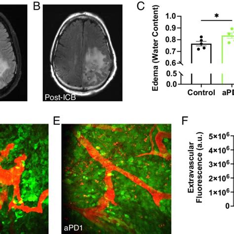 Icb Increases Gbm Vascular Leakage And Induces Brain Edema Mr