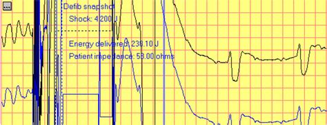 Double Sequential External Defibrillation Shock 1 Download