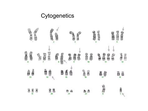 Multiple Myeloma PPT