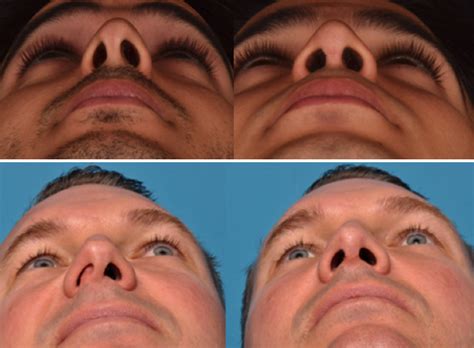 Nasal Septum Septoplasty What To Expect From Nasal Septum Surgery