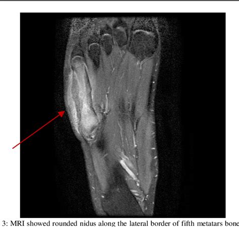 Figure 1 From A Rare Location For Osteoid Osteoma On The Foot A Case
