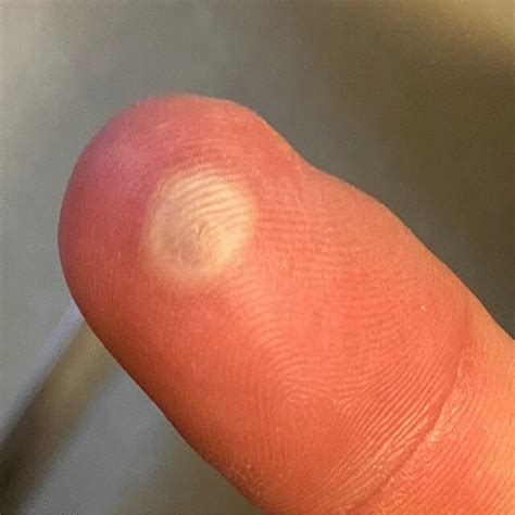 Further Development Of The Lesion Download Scientific Diagram