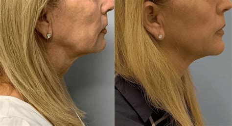 Sofwave San Mateo Ca Koch Facial Plastic Surgery