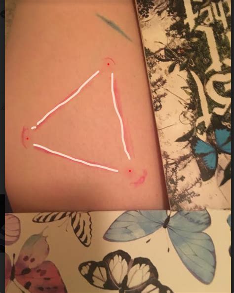 My Bug Bites Make A Triangle R Notinteresting