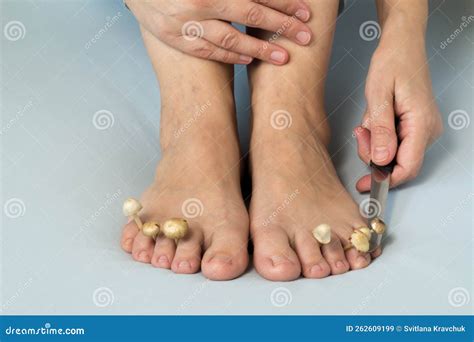 El Hongo Crece Entre Los Dedos De Los Pies Tratamiento De La Micosis