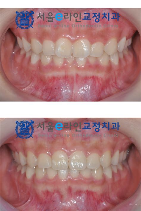 차님 치료후기 입니다 치료후기 평택교정치과 서울e라인교정치과