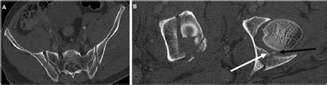 Preoperative Ct Axial Cuts Showing A Bilateral Crescent Fracture Download Scientific Diagram