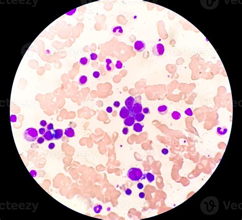 Photomicrograph Bone Marrow Study Megakaryocytic Hyperplasia 43292072
