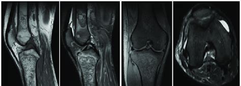 Magnetic Resonance Imaging Right Knee Shows Diffuse Marrow Infiltrative Download Scientific