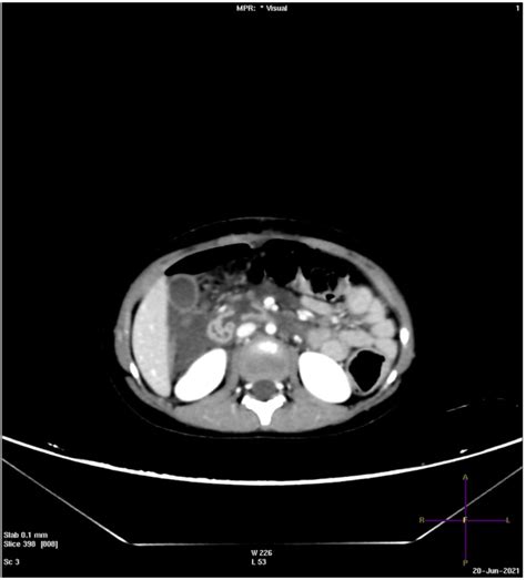 Axial Ct With Iv Contrast Perforation Seen In 3rd Part Of Duodenum