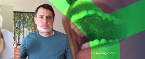 Tips And Jaw Exercises After Jaw Surgery Re Gain Your Strength Ach