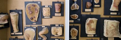 Medical Moulage Collection FAU Erlangen Nürnberg