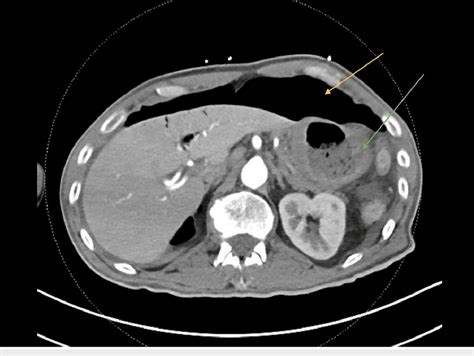 Ct Scan Of The Abdomen With Intravenous Contrast Showing Large Volume