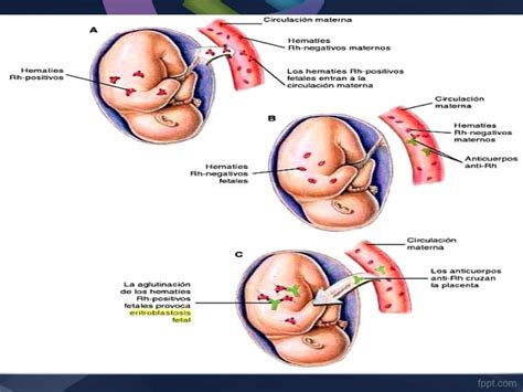 Eritroblastosis Fetal