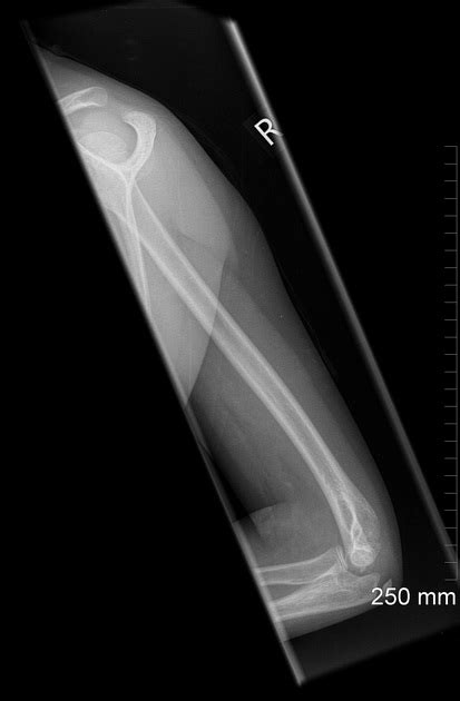 Normal Humerus X Ray