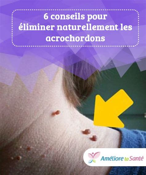 6 conseils pour éliminer naturellement les acrochordons Remèdes