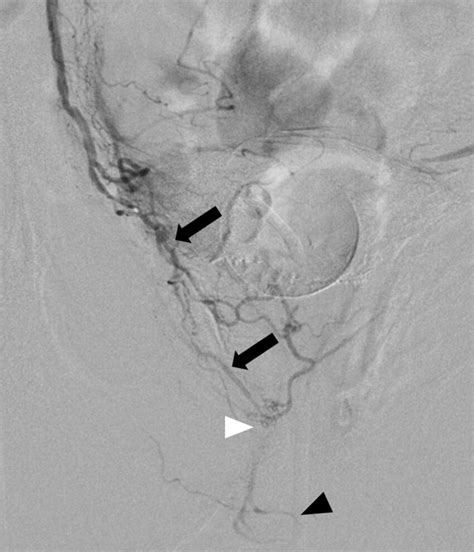 Superselective Digital Subtraction Angiogram Of The Right Download Scientific Diagram