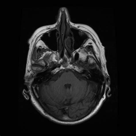 Radiopaedia Case Cortical Laminar Necrosis Id 18928 Study 18885 Nc