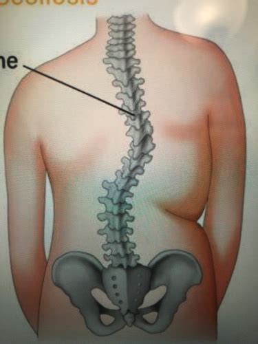 Pathologies Erectors And Deep Vertebral Muscles Flashcards Quizlet