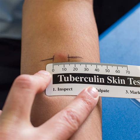 What Does A Positive Tb Skin Test Look Like