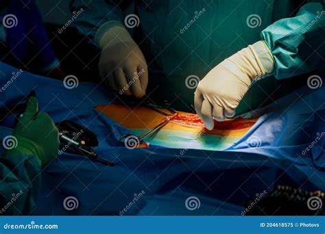 Deep Incision With Using Electrical Scalpel Pencil To Stop The Bleeding