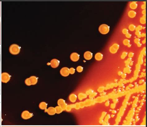 Deadly Superbug Scare Boston Herald