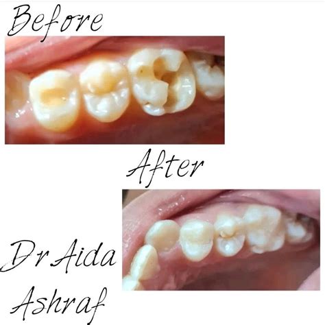 Aida Ashraf On Linkedin Class I Composite 🦷