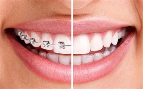 Aparat dentar când este nevoie de el şi la ce vârste se montează Doftoria ro